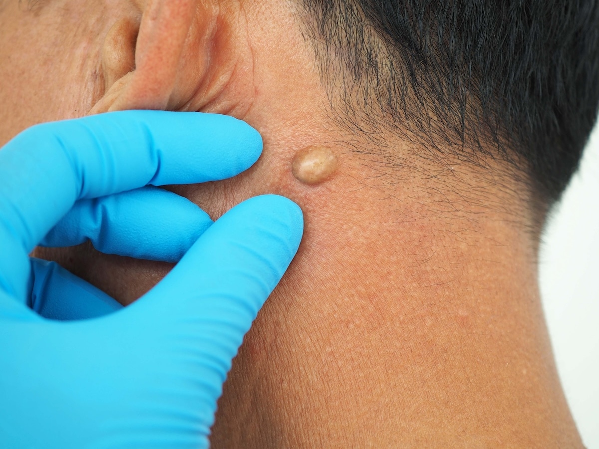 Cyst Lipoma Removal In Upland Skin Physicians Surgeons cyst-lipoma-removal-in-upland-skin-physicians-surgeons