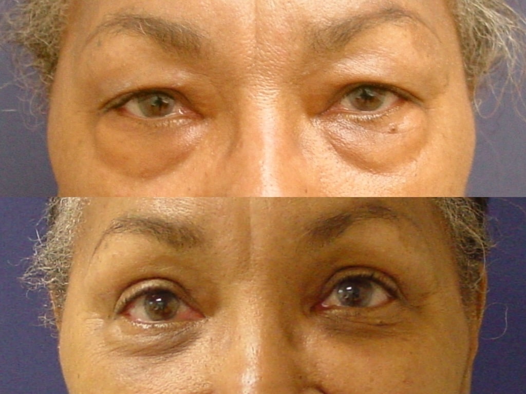 Eyelid Lift Treatment in Upland, CA | Skin Physicians & Surgeons