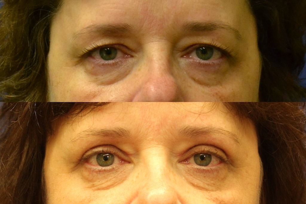 Eyelid Lift Treatment in Upland, CA | Skin Physicians & Surgeons